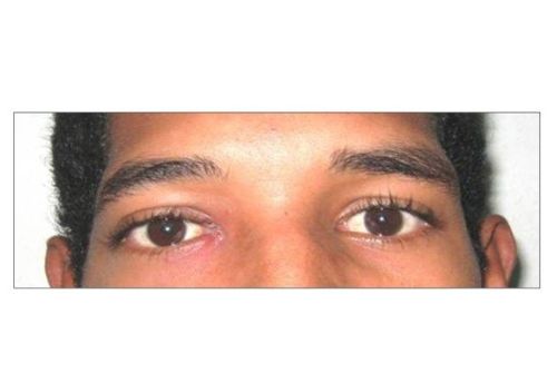 Celulitis orbitaria. Presentación de un caso | González García ...