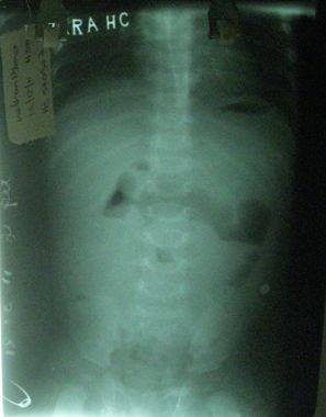 Oclusión intestinal por Bridas Congénitas. Presentación de un caso ...