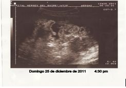 Oclusión intestinal por Bridas Congénitas. Presentación de un caso ...